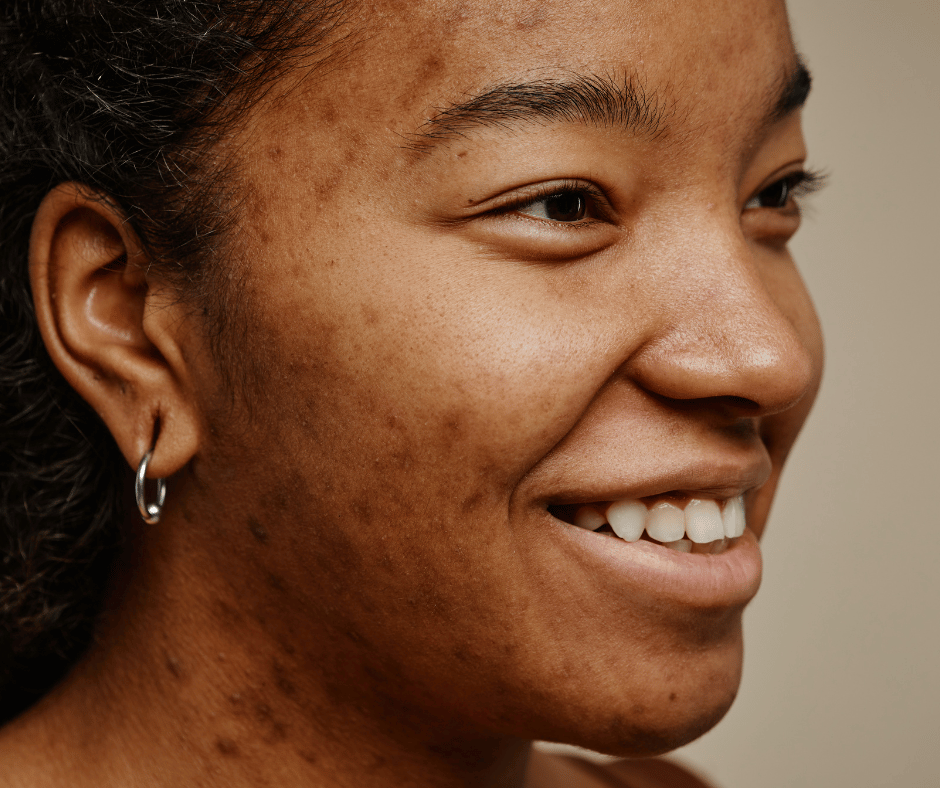 3 Natural Hyperpigmentation Remedies To Try! – Fushi Wellbeing